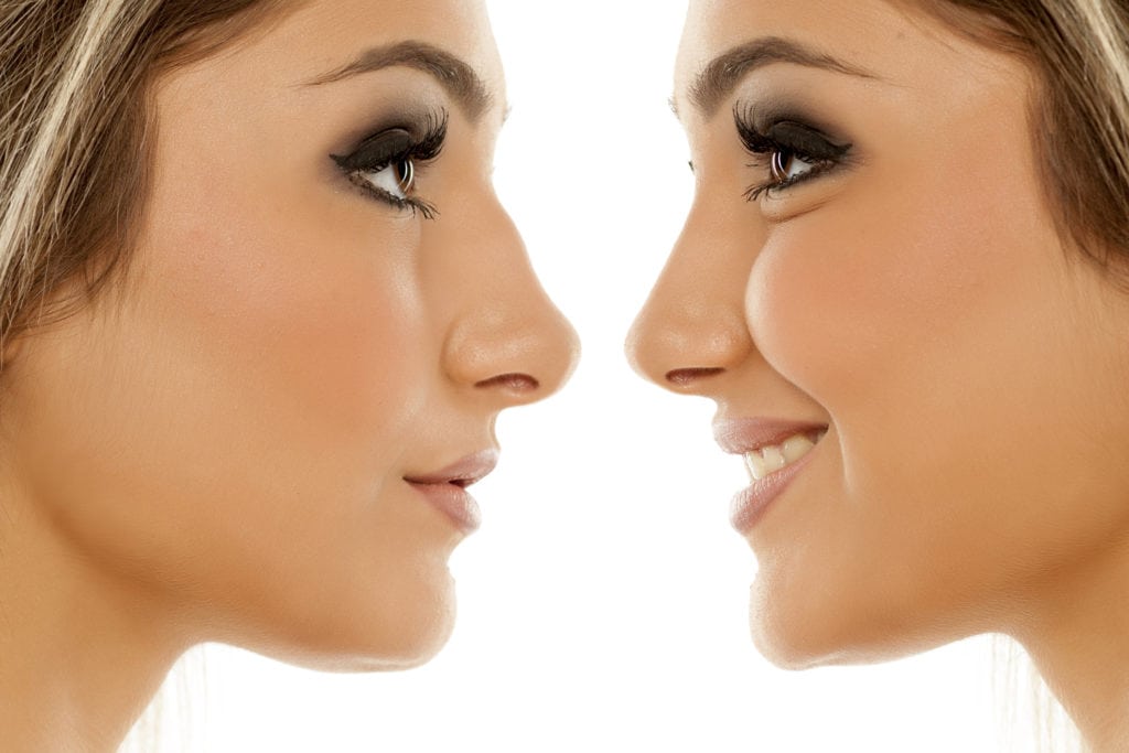Ketahui Hal ini, Sebelum Menjalani Rhinoplasty atau Nose Job
